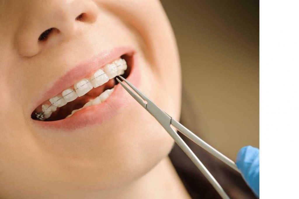 InBrace Braces in Colorado Springs, Pueblo, & Canon City CO